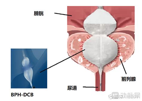 启维医疗：引领国内前列腺治疗新变革，首款药物球囊导管蓄势待发 在男性健康领域，良性前列腺增生症（bph）是一种随着年龄增长，发病率显著攀升的常见疾病。数据显示，50岁男性的患病率约为 雪球