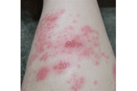 帯状疱疹の初期症状を見逃さないためのポイント きなが内科・内視鏡クリニックブログ