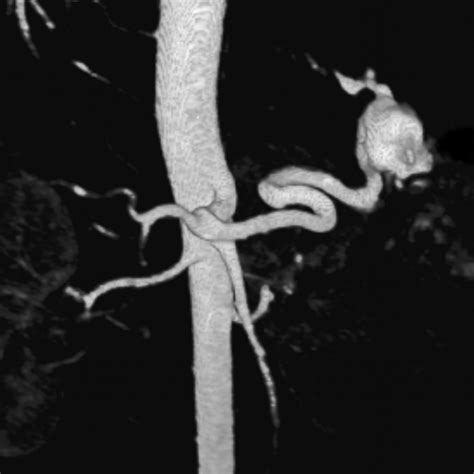Visceral Artery Aneurysm Icd 10