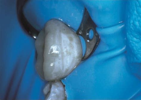 Post Operative Photograph At Once After Cementation Download