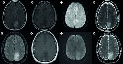 When Tumefactive Demyelination Is Truly A Tumor Case Report Of A Radiographic Misdiagnosis Pmc