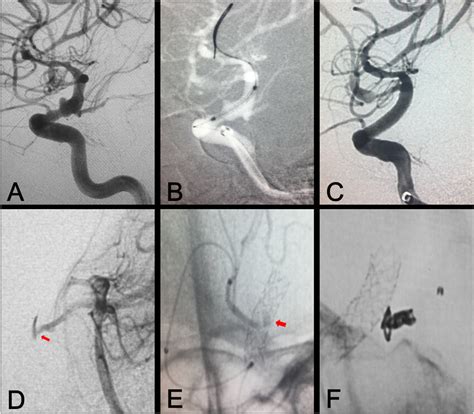 Embolization Of Branch Artery For Type Ii Endoleak A Pre Procedural Download Scientific