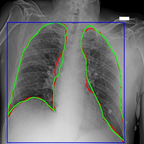 Example Of The Lung Segmentation Results Green Line Manual Download Scientific Diagram