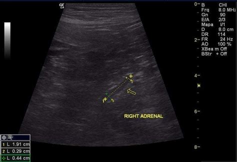 Hypoadrenocorticism Members