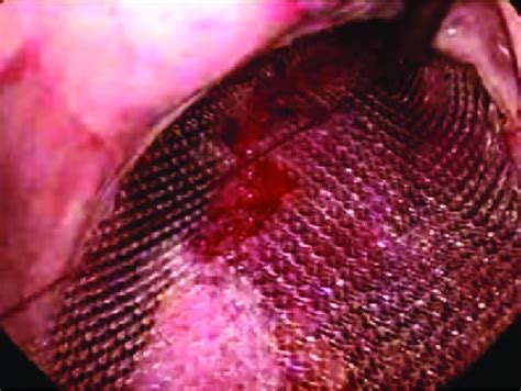 Insertion Of The Mesh Download Scientific Diagram