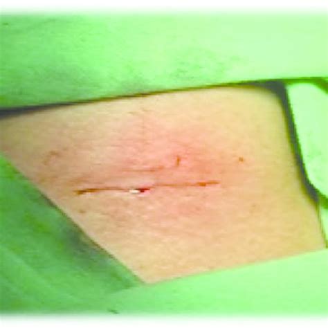 Thyroidectomy With Harmonic Scalpel Using Minimally Invasive Open