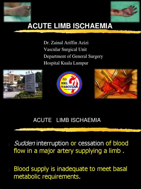 Acute Limb Ischaemia Ischemia Thrombosis