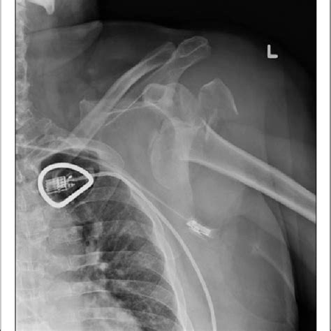 Complex Anterior Fracture Dislocation Of The Proximal Humerus