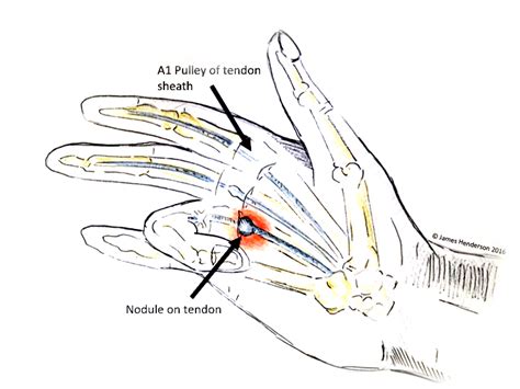 Trigger Finger Trigger Thumb James Henderson Specialist Plastic