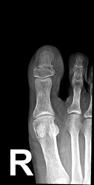 Distal Phalanx Foot X Ray
