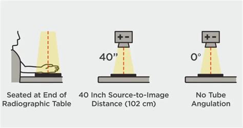A Radiographers Guide To Lateral Finger X Ray Imaging Hsin Film