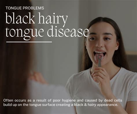 Smile Black Hairy Tongue Is A Condition That Makes The Tongue