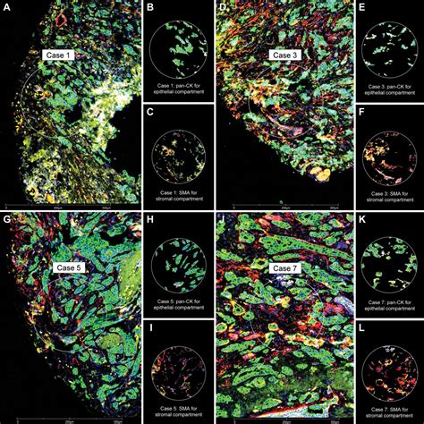 Spatial Transcriptomic Profiling Reveals Gene Expression Characteristics In Lymph Node Positive