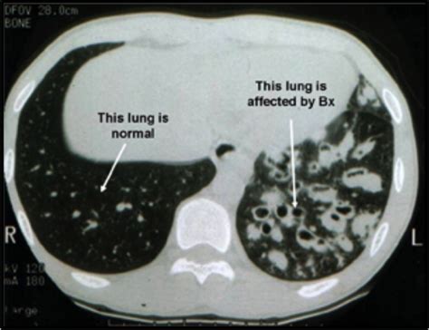 Bronchiectasis Flashcards Quizlet