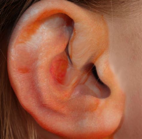 Figure Auricular Hematoma The Outer Ear Statpearls Ncbi