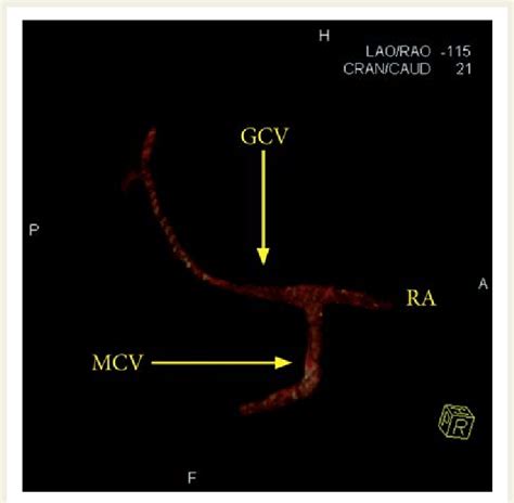 Dual Source Computed Tomography The Same Patient As In Figure 1 The