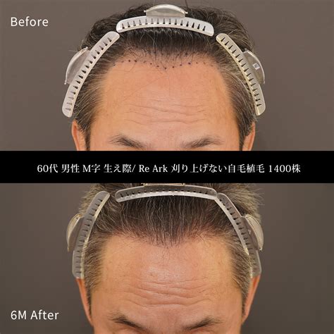 【re Ark 刈り上げない自毛植毛1400株】 症例紹介 自毛植毛ならaga By Ark Clinic