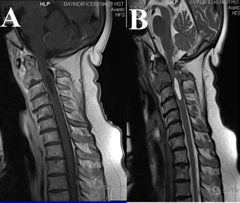 Dislocated Neck Vertebrae
