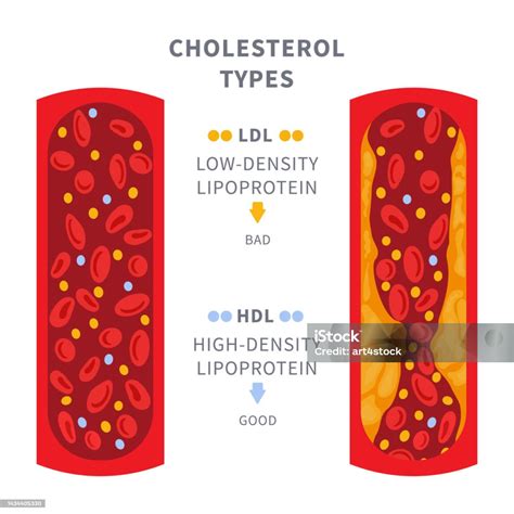 Normal And Blocked Artery With Cholesterol Clot Infographics Stock
