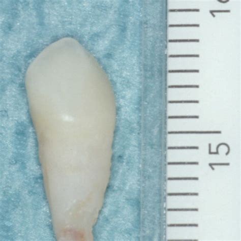 Patient 5 Clinical View Of The Exfoliated Mandibular Right Cuspid Download Scientific Diagram