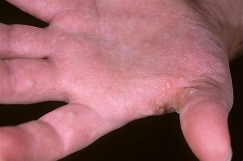 У ребенка сыпь с пузырьками волдыри на теле и температура