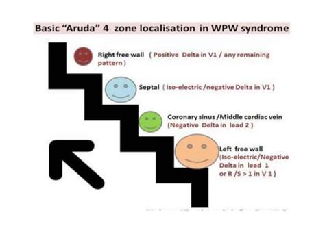 Localization Of Wpw Accessory Pathway By Surface Ecg Ppt
