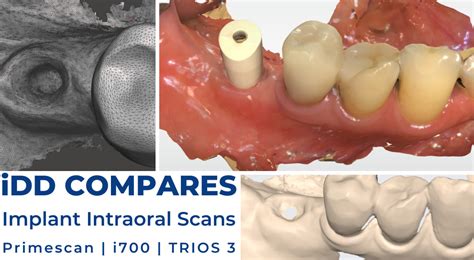 Intraoral Scanner Comparison Scan Body And Implant Scans