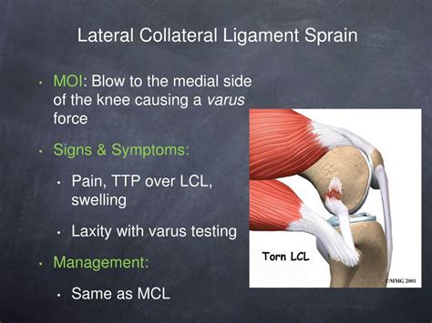 Ligament Tear