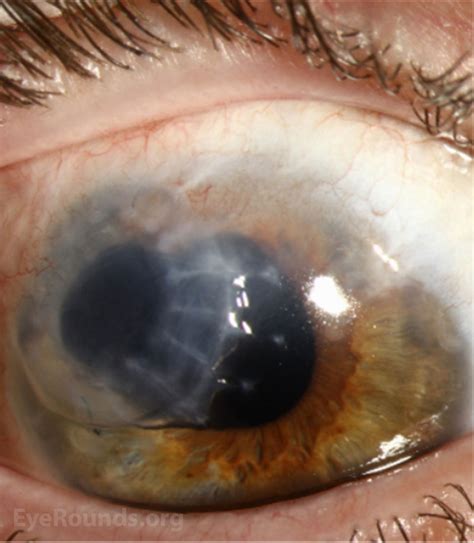 Terrien Marginal Degeneration