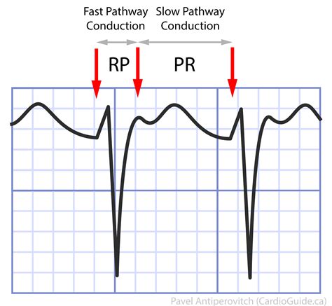 Narrow Qrs Regular Tachycardia Cardio Guide