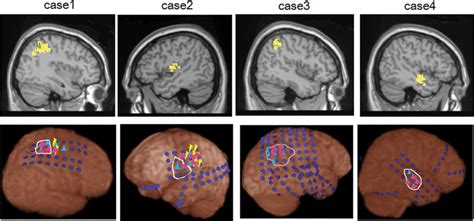 Eeg Source Estimation Upper Deeg Source Estimation By Deeg Download Scientific Diagram