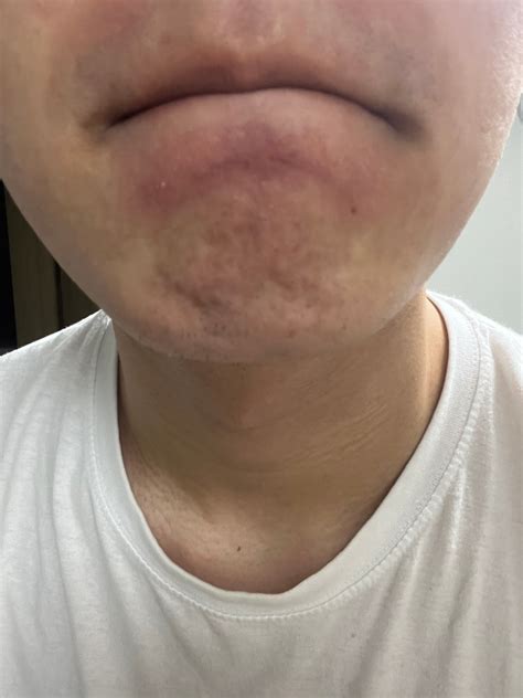 입술 밑 피부 왜 이런가요 지식in