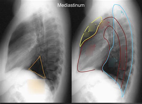 Lateral Cxr And Mediastinal Structures Diagram Quizlet
