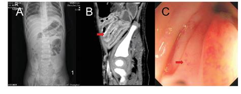 Figure 1 From Pediatric Severe Pseudomembranous Enteritis Treated With