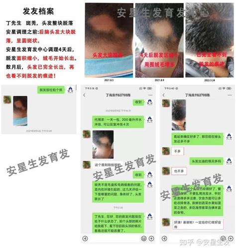 美批准首种斑秃口服药，安星生发：我们已帮助很多斑秃者恢复正常 知乎