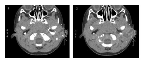 A1 2 Case 2 Axial Ct Scan Of The Neck With Contrast Demonstrating