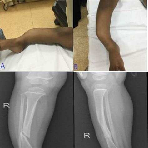 Anteroposterior Ap And Lateral Views Of The Right Leg Showing Tibial