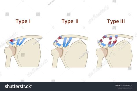 Three Stages Acromioclavicular Joint Dislocation Stock Vector Royalty Free 2375095761
