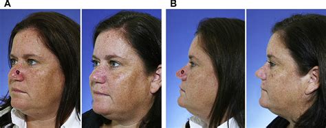 Bilobed Flaps In Nasal Reconstruction Facial Plastic Surgery Clinics