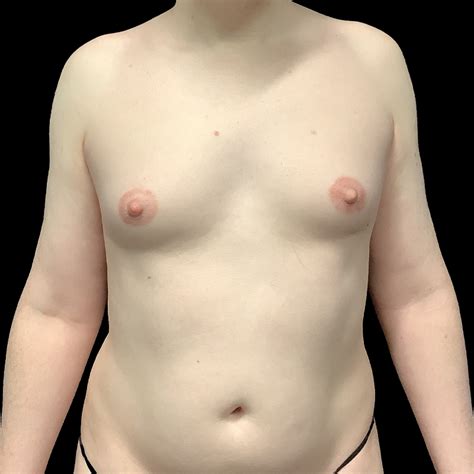 Mtf Breast Augmentation Before And After 35 Dr Sajan