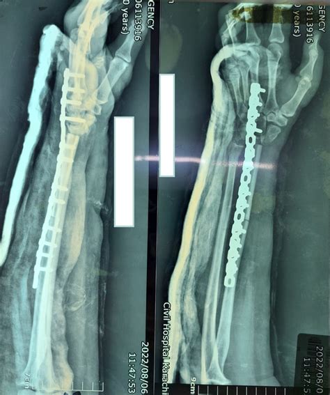After Marginal Resection And Reconstruction With Fibular Graft And