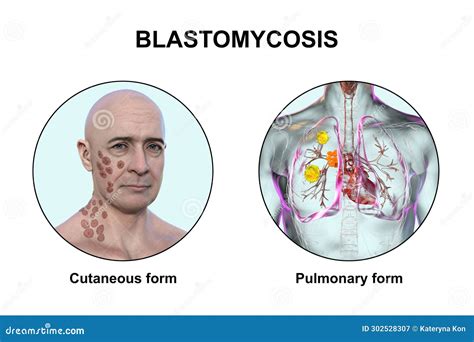 Clinical Forms Of Blastomycosis 3d Illustration Royalty Free Cartoon 305667227