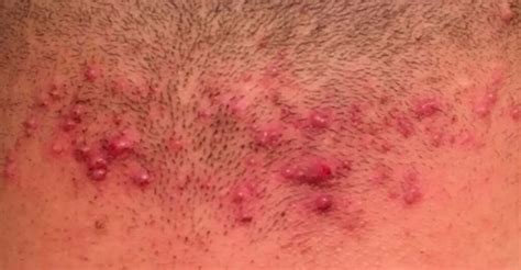 Foliculitis Una Indicación Para El Tratamiento De Depilación Láser Airklinic