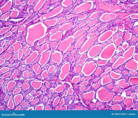 Follicular Adenoma Thyroid