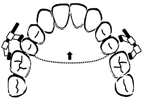 Maxillary Protraction Distraction Device Adjustable In Direction And Clinic Application Thereof
