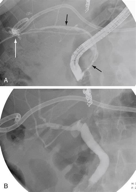 Endoscopic And Radiologic Treatment Of Biliary Disease Clinical Tree