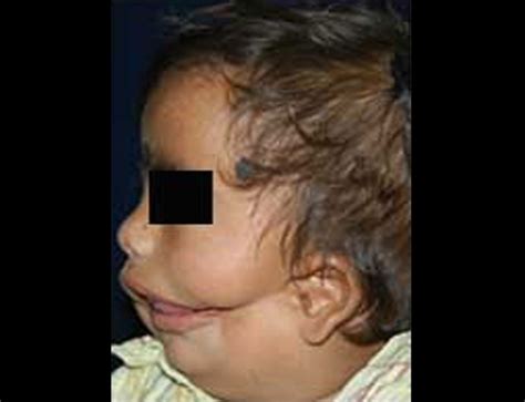 Hemifacial Microsomia Hyderabad Cleft Society