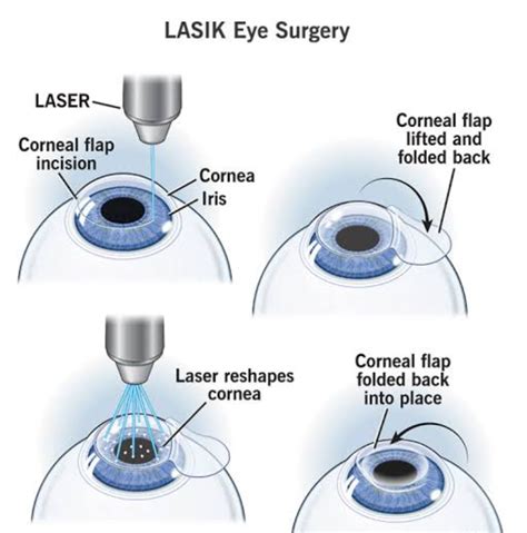 Pathophysiology Of Refractive Errors Understanding Visual Abnormalities Optography