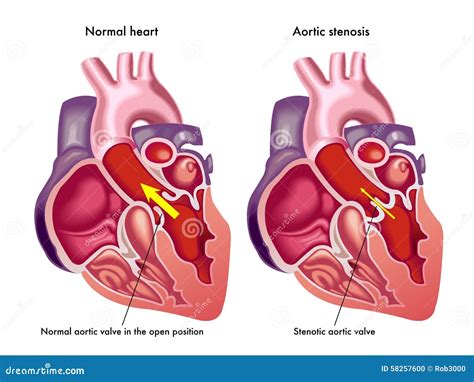 Aortic Stenosis Stock Illustration Illustration Of Obstruction 58257600