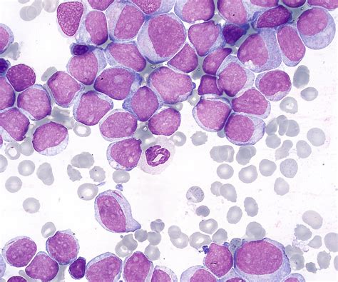 Fileacute Myeloid Leukemia M2 Type Wikimedia Commons